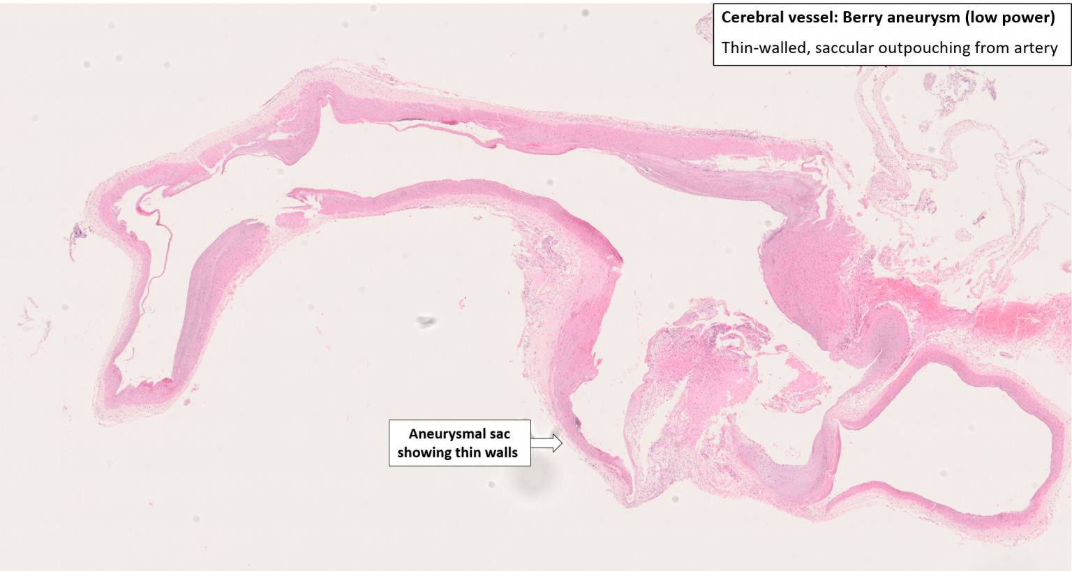 Brain – Aneurysm – NUS Pathweb :: NUS Pathweb
