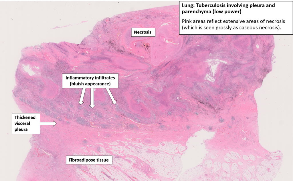 Lung – Tuberculosis with Cavitation – NUS Pathweb :: NUS Pathweb