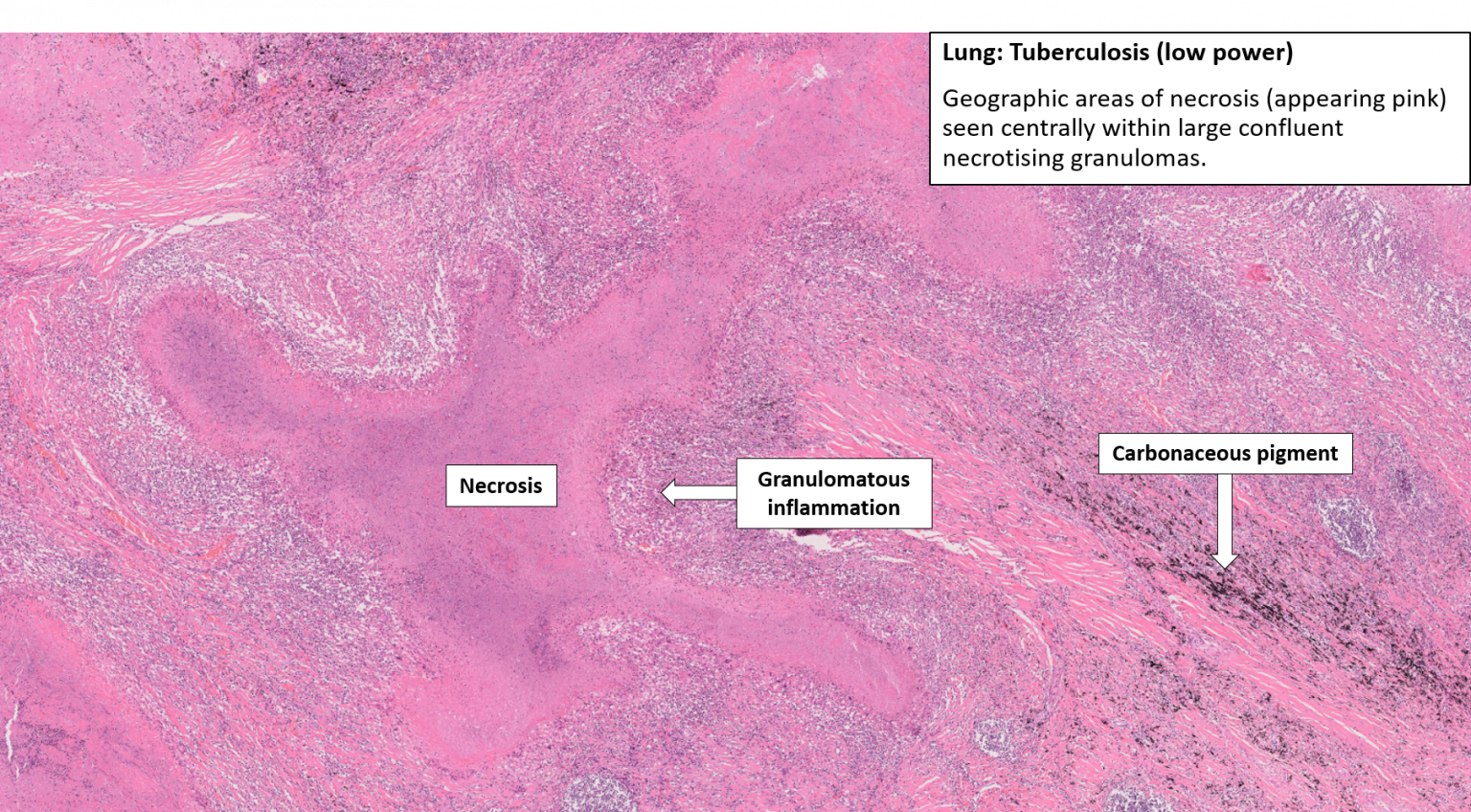 Lung – Tuberculosis with Cavitation – NUS Pathweb :: NUS Pathweb