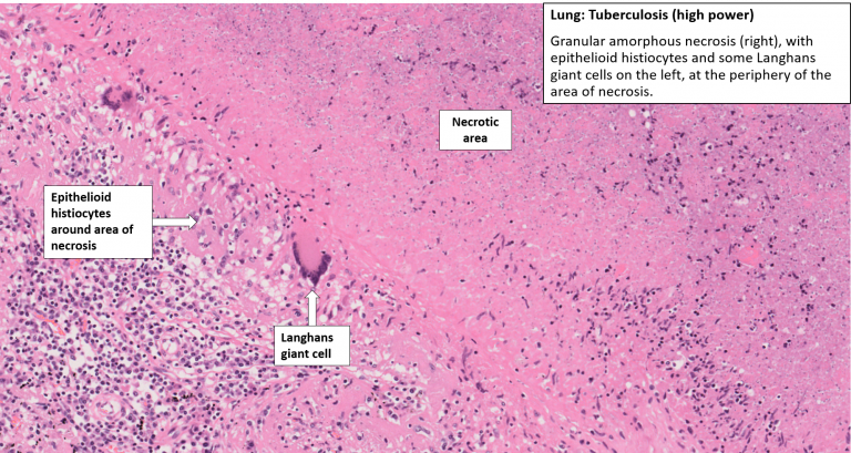 Lung and Lymph Nodes – Tuberculosis with Primary Complex – NUS Pathweb ...