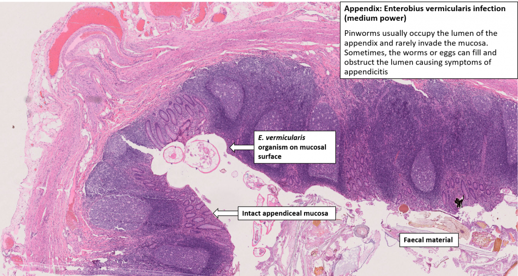 Appendix – Acute Appendicitis – NUS Pathweb :: NUS Pathweb