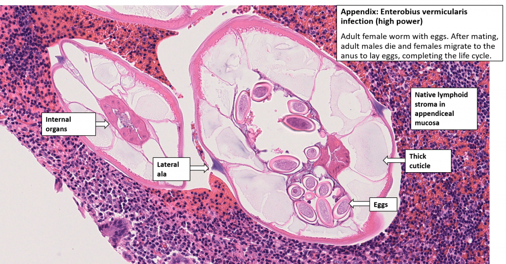 Appendix – Acute Appendicitis – NUS Pathweb :: NUS Pathweb