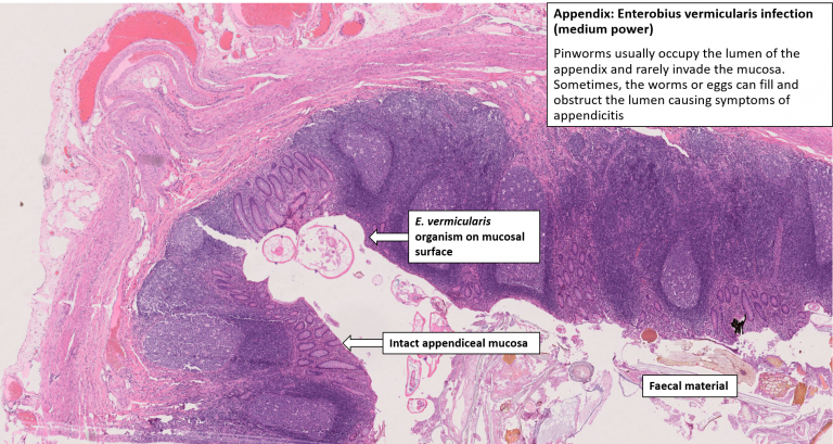 Appendix – Acute Appendicitis – NUS Pathweb