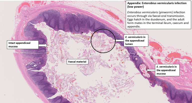 Appendix – Acute Appendicitis – NUS Pathweb :: NUS Pathweb
