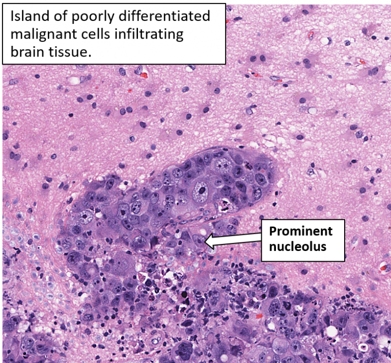Brain – Secondary Carcinoma – NUS Pathweb :: NUS Pathweb