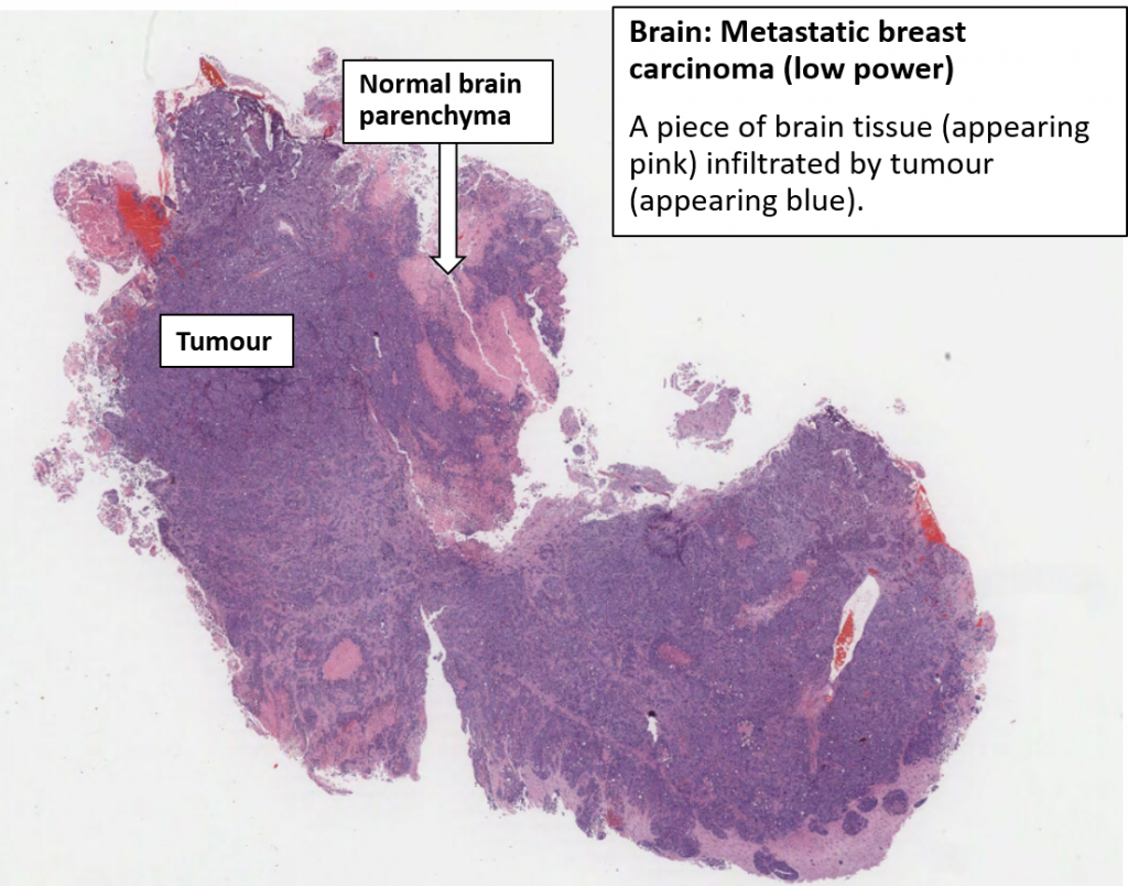 Brain – Secondary Carcinoma – NUS Pathweb :: NUS Pathweb