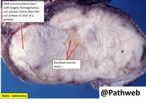 Testis – Seminoma – NUS Pathweb :: NUS Pathweb