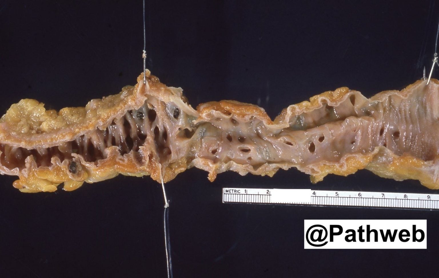 Diverticular Disease Of Large Intestine Icd 10 - Design Talk