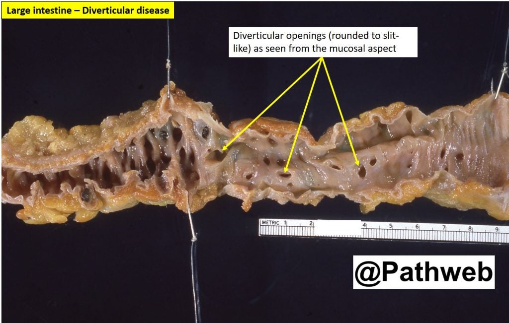 Large Intestine – Diverticular Disease – NUS Pathweb :: NUS Pathweb