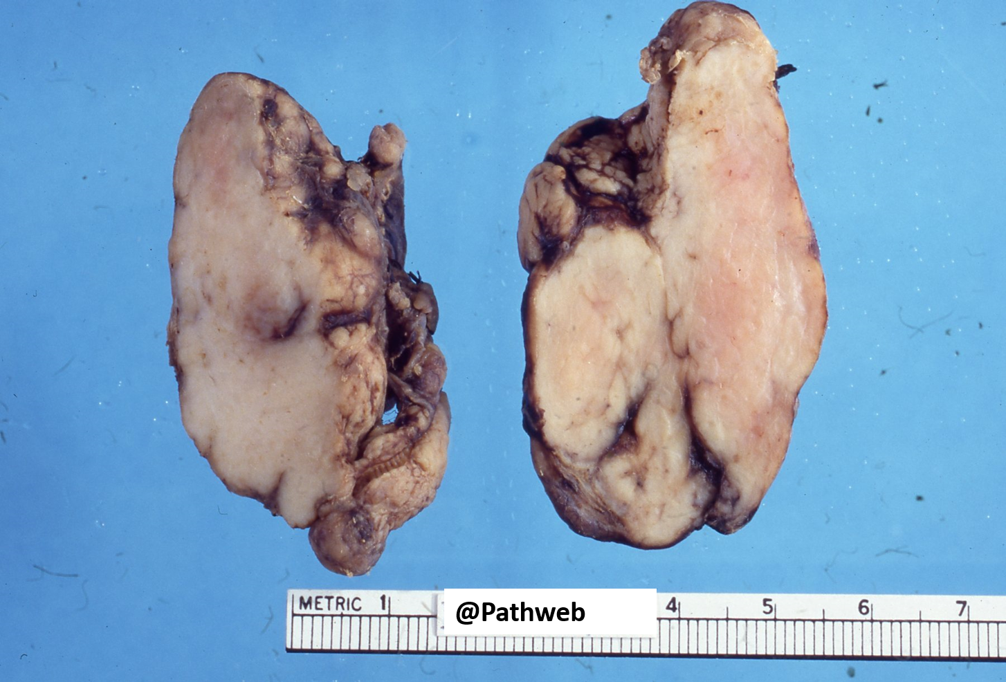 Thyroid – Hashimoto Thyroiditis – NUS Pathweb :: NUS Pathweb