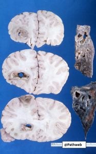 Brain – Abscess – NUS Pathweb :: NUS Pathweb