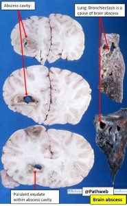 Brain – Abscess – NUS Pathweb :: NUS Pathweb