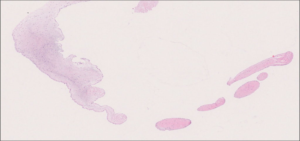 Atrioventricular valve with chordae tendineae – Normal Histology – NUS ...