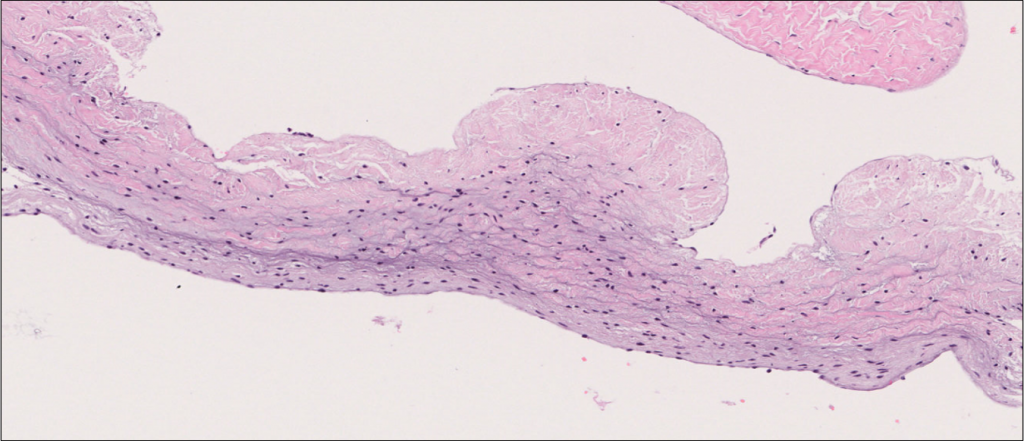 Atrioventricular valve with chordae tendineae – Normal Histology – NUS ...