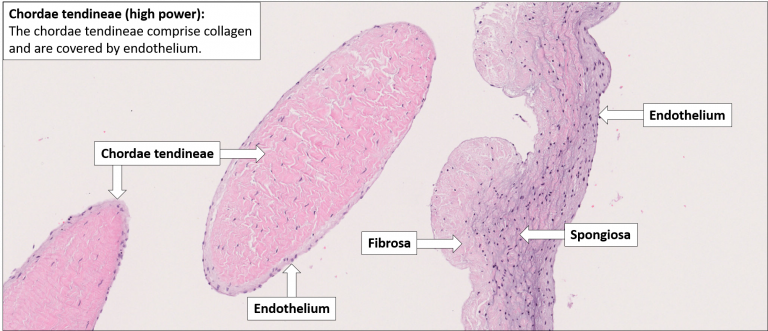 Atrioventricular valve with chordae tendineae – Normal Histology – NUS ...