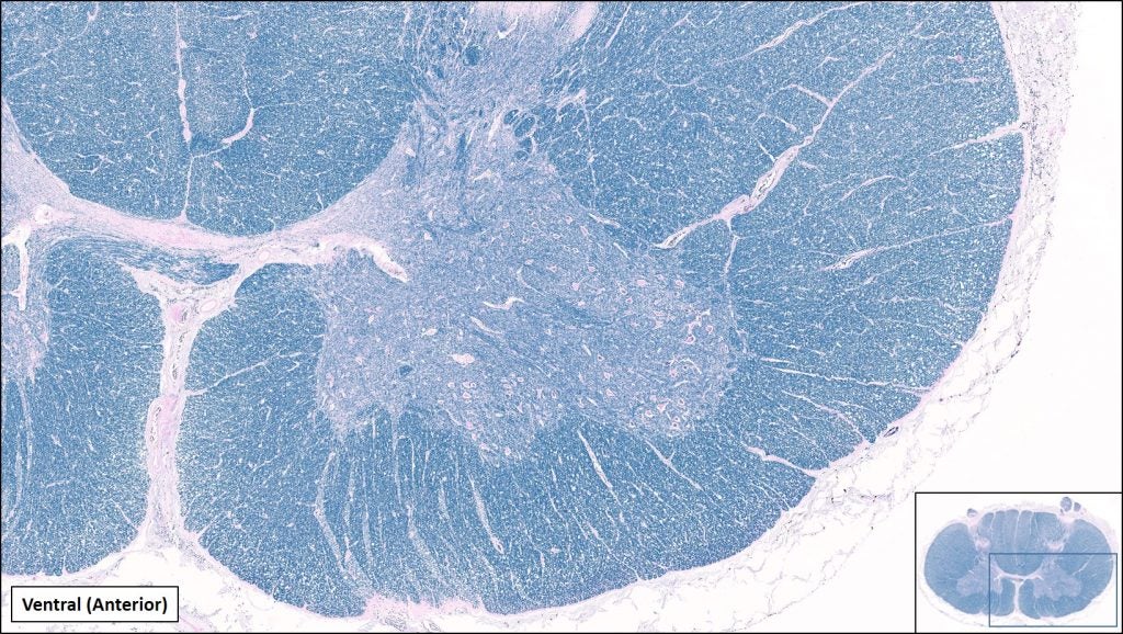Spinal cord – NUS Pathweb :: NUS Pathweb