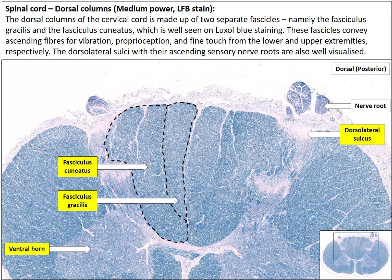 Spinal cord – NUS Pathweb :: NUS Pathweb
