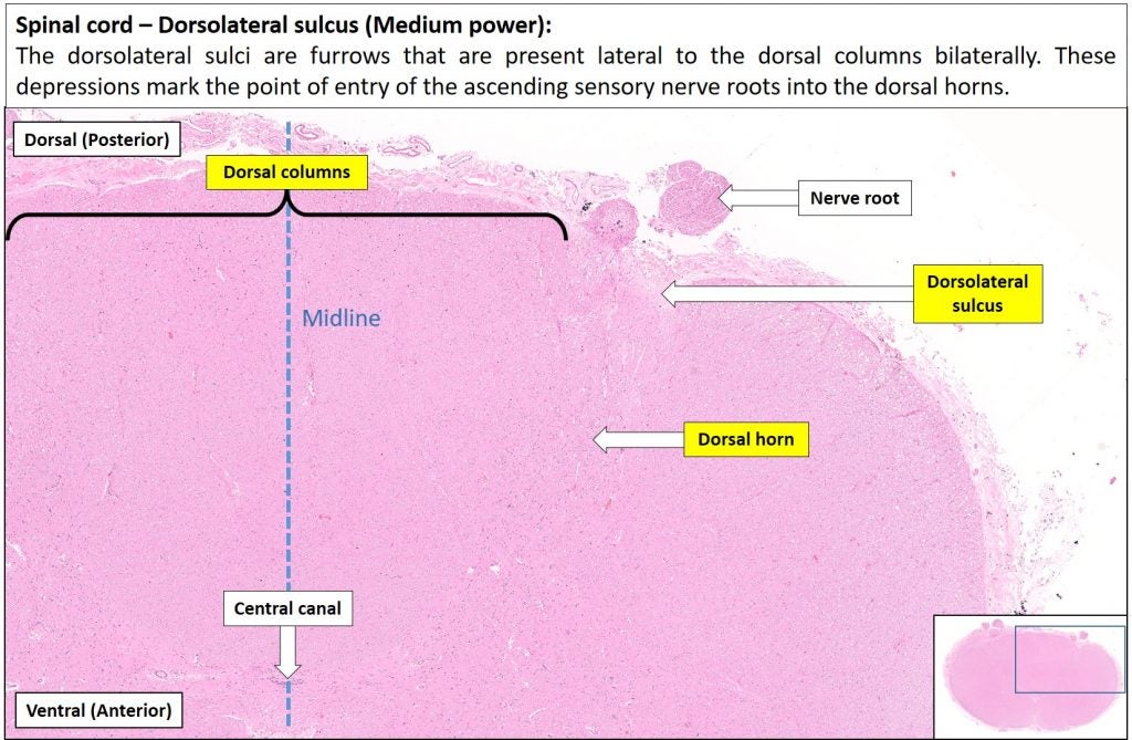 Spinal cord – NUS Pathweb :: NUS Pathweb