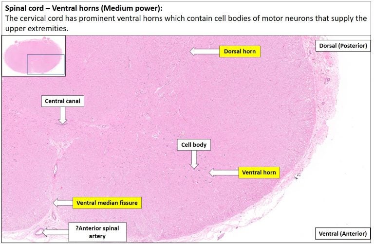 Spinal cord – NUS Pathweb :: NUS Pathweb