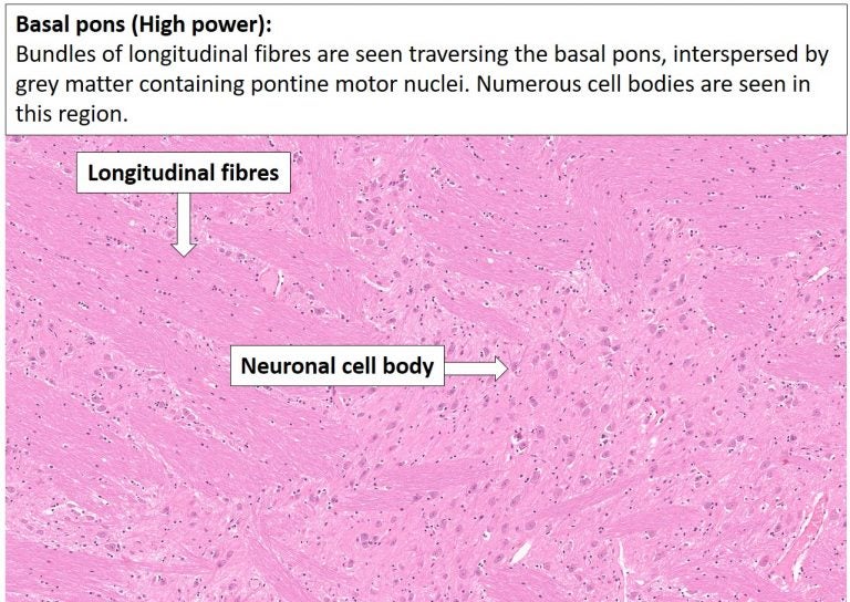 Brain – Pons – NUS Pathweb :: NUS Pathweb