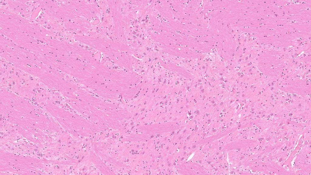 Brain – Pons – NUS Pathweb :: NUS Pathweb