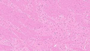 Brain – Pons – NUS Pathweb :: NUS Pathweb