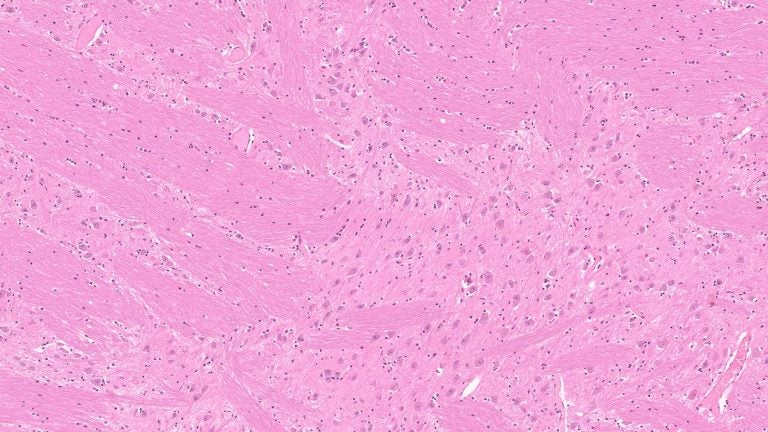 Brain – Pons – NUS Pathweb :: NUS Pathweb