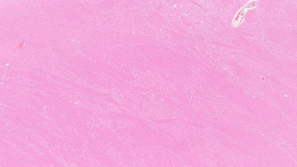 Brain – Pons – NUS Pathweb :: NUS Pathweb