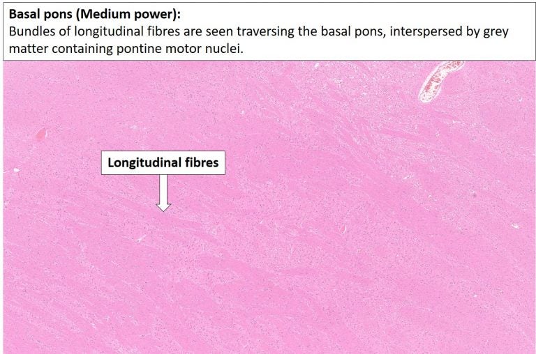 Brain – Pons – NUS Pathweb :: NUS Pathweb