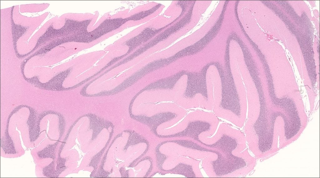 Brain – Cerebellum – NUS Pathweb :: NUS Pathweb