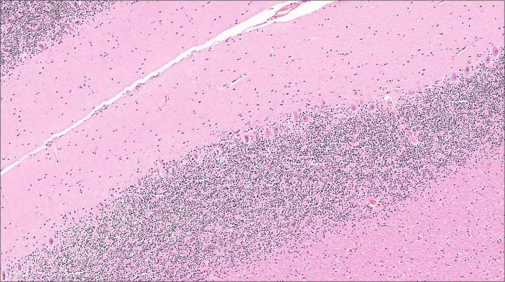 Brain – Cerebellum – NUS Pathweb :: NUS Pathweb