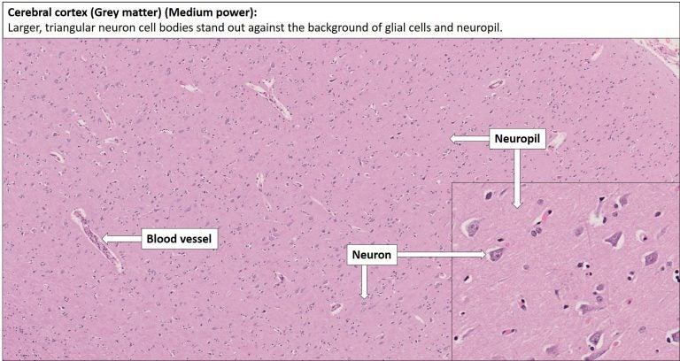 Brain – Cerebrum – NUS Pathweb :: NUS Pathweb