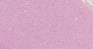 Brain – Cerebrum – NUS Pathweb :: NUS Pathweb