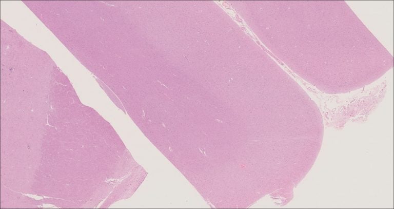 Brain – Cerebrum – NUS Pathweb :: NUS Pathweb