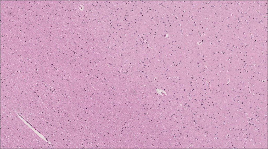 Brain – Cerebrum – NUS Pathweb :: NUS Pathweb