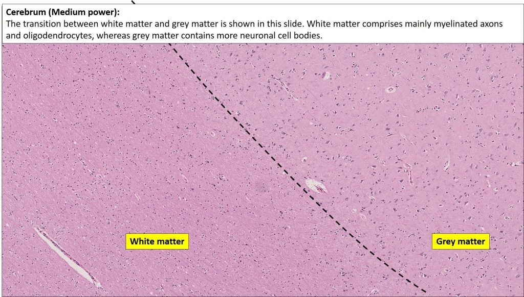 Brain – Cerebrum – NUS Pathweb :: NUS Pathweb