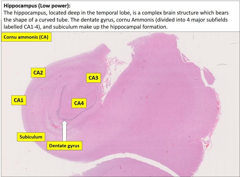 Brain – Hippocampus – NUS Pathweb :: NUS Pathweb