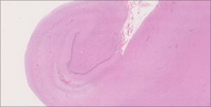 Brain – Hippocampus – NUS Pathweb :: NUS Pathweb