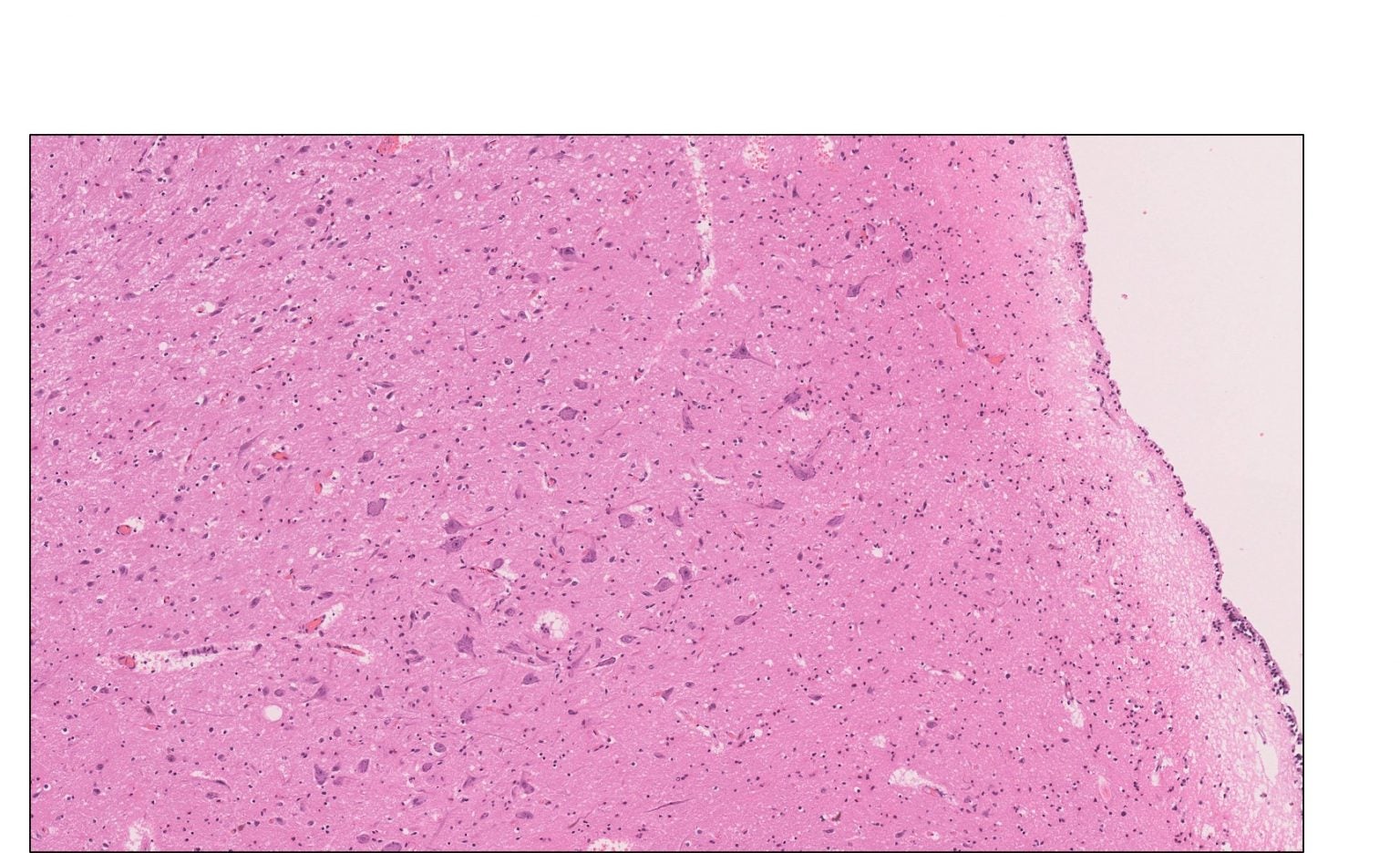 Brain – Medulla – NUS Pathweb :: NUS Pathweb