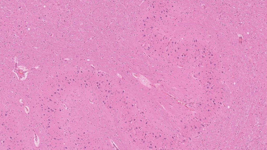 Brain – Medulla – NUS Pathweb :: NUS Pathweb