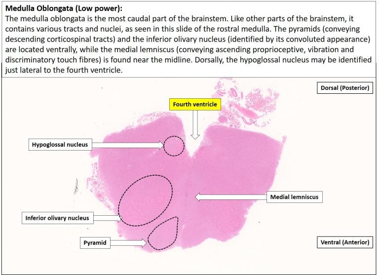 Brain – Medulla – NUS Pathweb :: NUS Pathweb