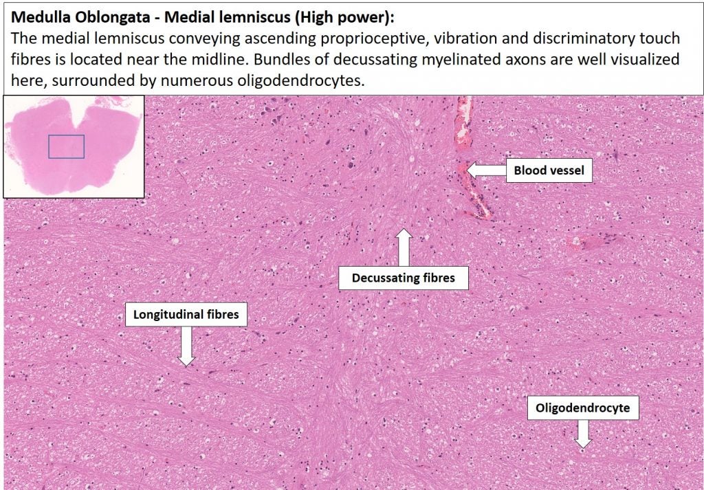 Brain – Medulla – NUS Pathweb :: NUS Pathweb