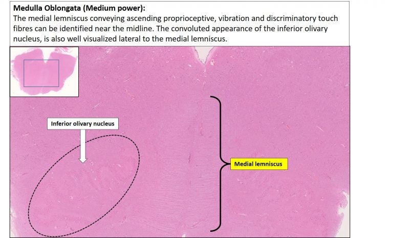 Brain – Medulla – NUS Pathweb :: NUS Pathweb