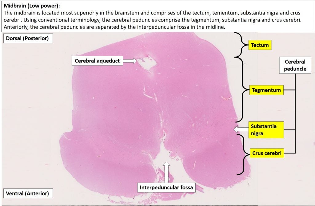 Brain – Midbrain – NUS Pathweb :: NUS Pathweb