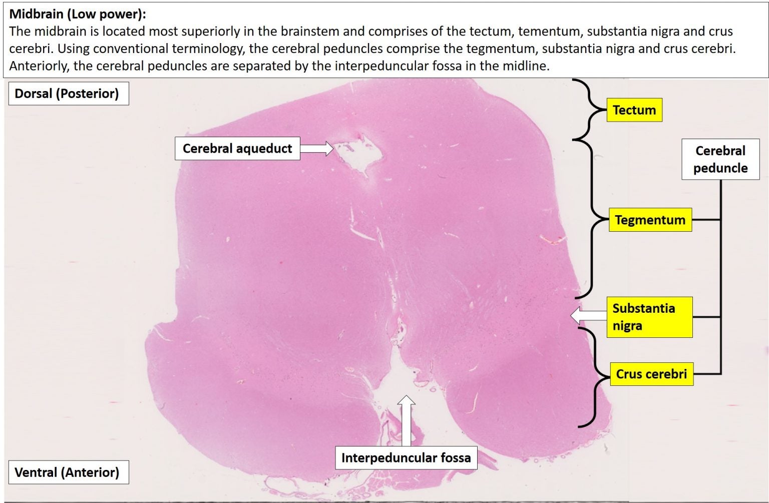 Brain – Midbrain – NUS Pathweb :: NUS Pathweb