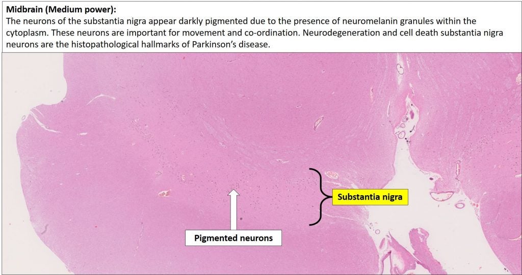Brain – Midbrain – NUS Pathweb :: NUS Pathweb