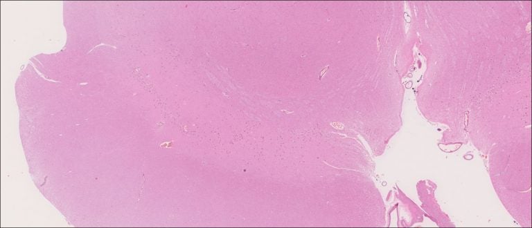 Brain – Midbrain – NUS Pathweb :: NUS Pathweb