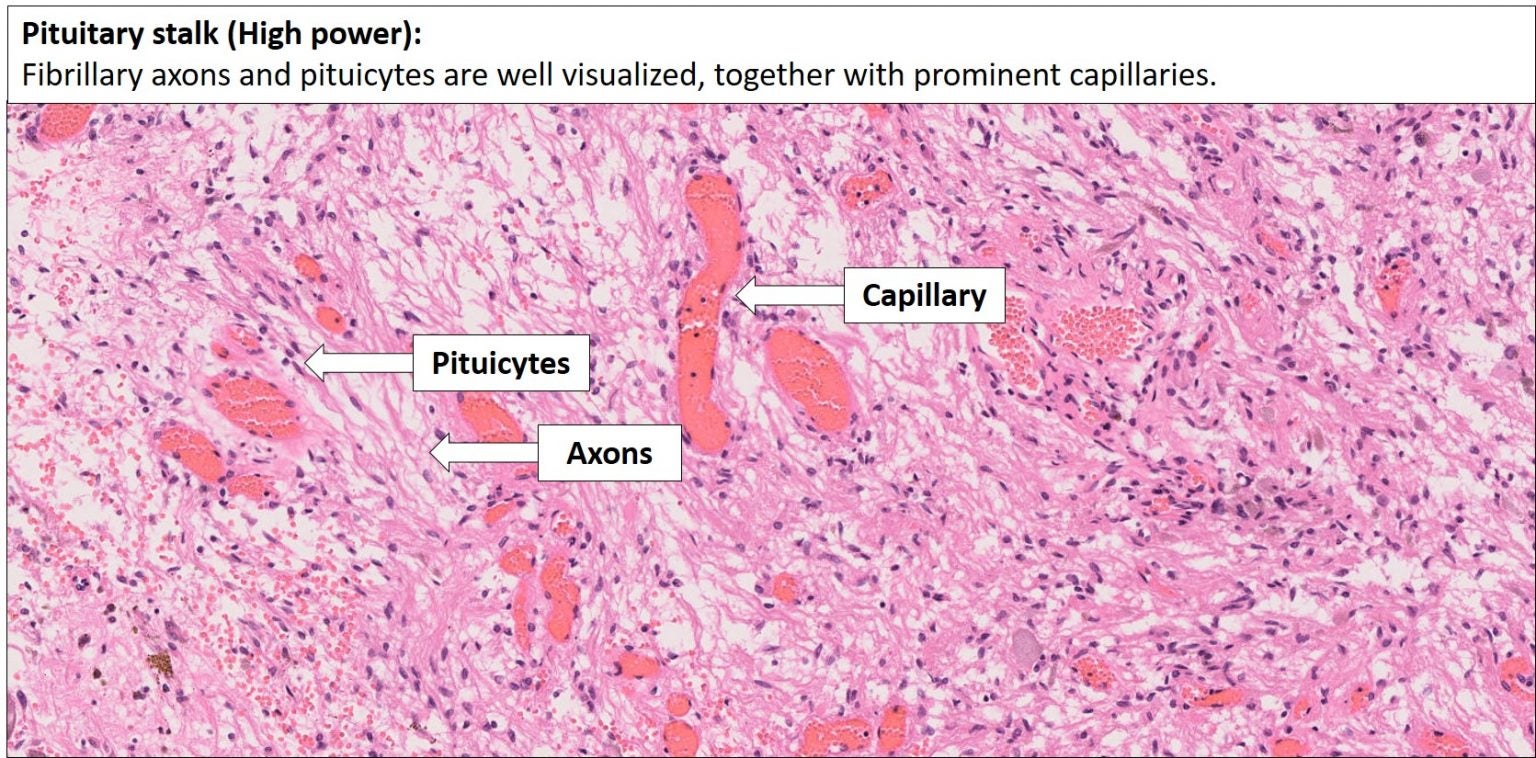 Brain – Pituitary – NUS Pathweb :: NUS Pathweb