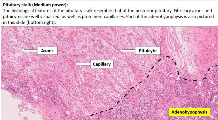 Brain – Pituitary – NUS Pathweb :: NUS Pathweb