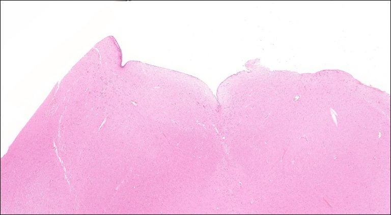 Brain – Pons – NUS Pathweb :: NUS Pathweb